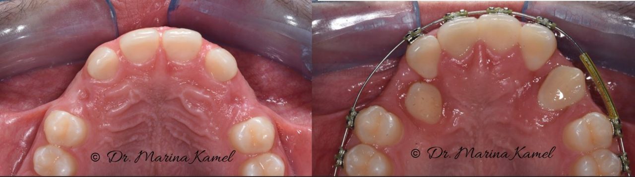 Canine Exposures | Westside Perio Dental Clinic