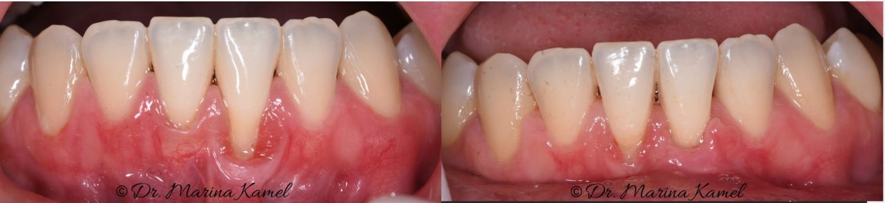 Recession Coverage | Westside Perio Dental Clinic