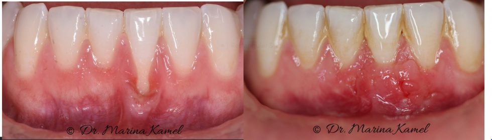 Recession Coverage | Westside Perio Dental Clinic